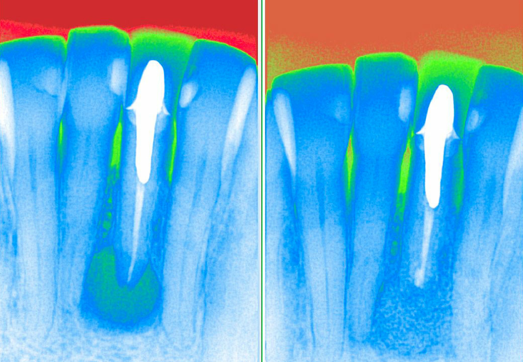 Résection apicale Chirurgie buccale - Dentiste Paris Auteuil
